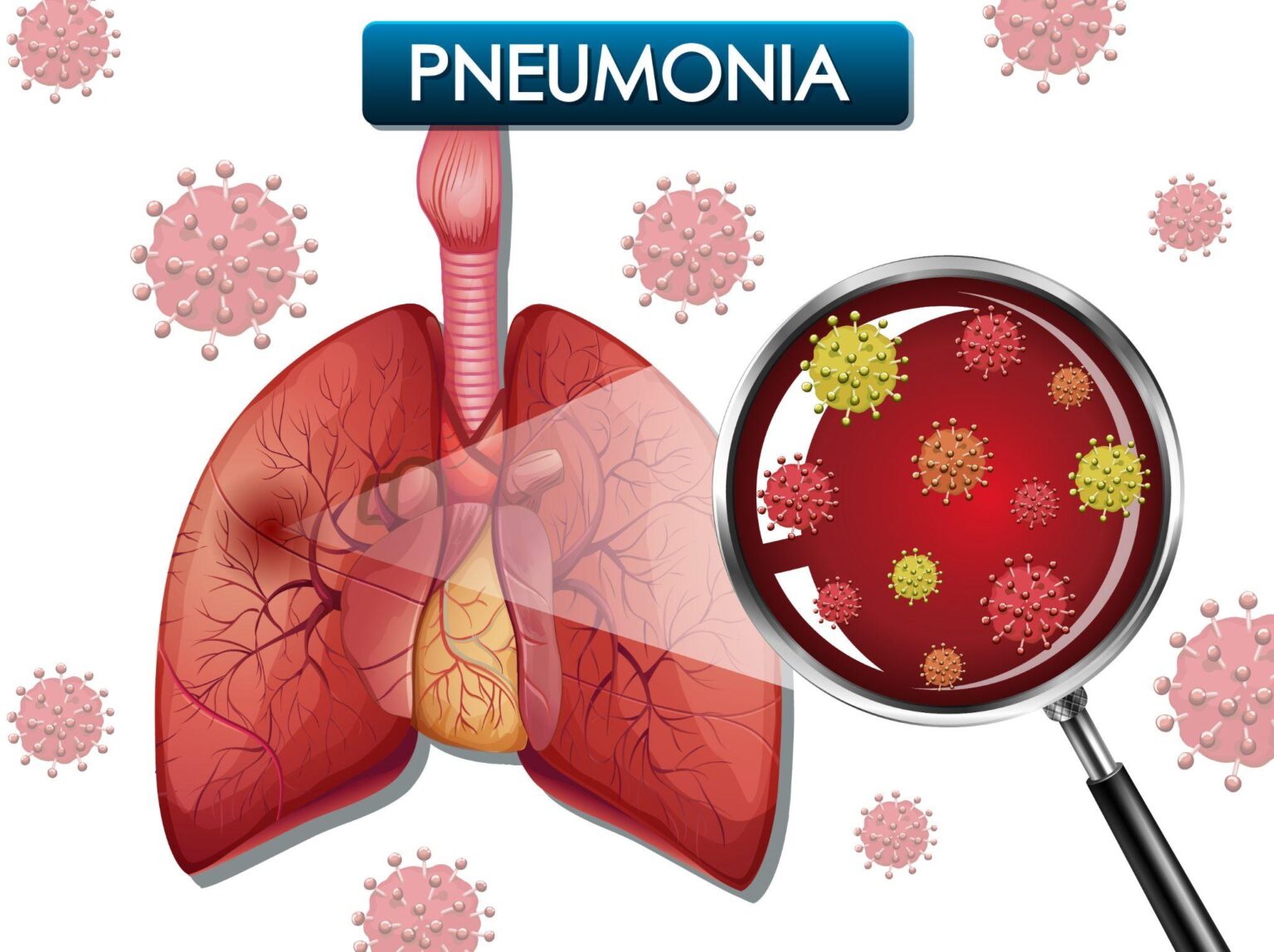 Pneumonia: Early Symptoms and Treatment Options - MY DR'S NOTE