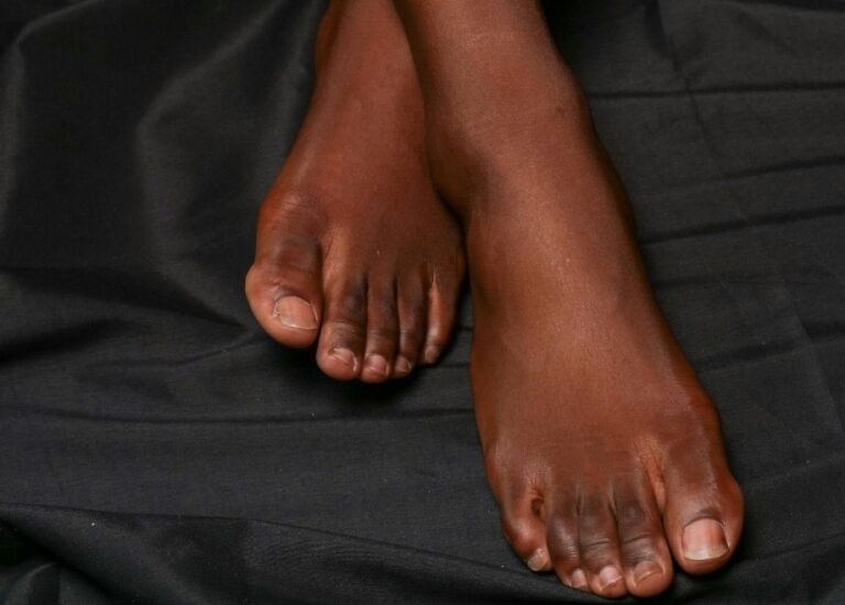 Fungal Infections: Athlete’s Foot, Ringworm, and Prevention Tips - MY ...