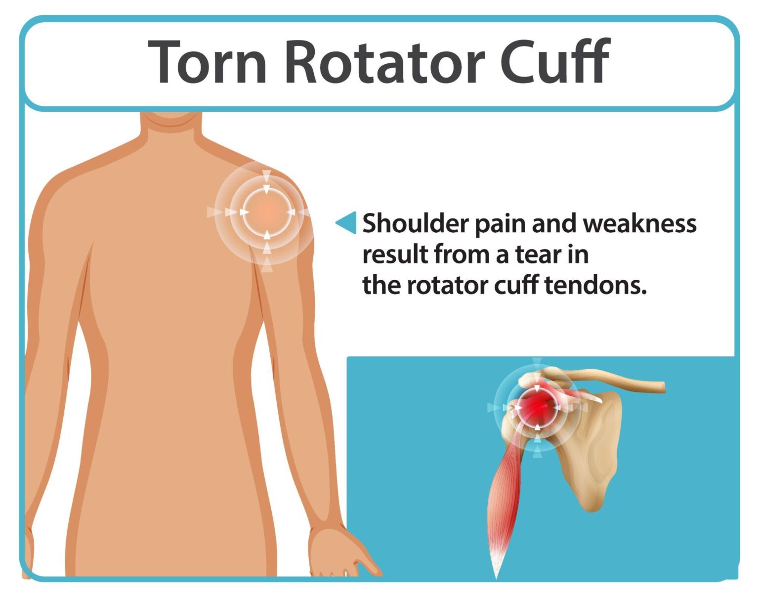 The Complete Guide to Musculoskeletal Injuries: Understanding ...